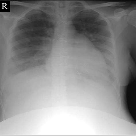 3 Days After Admission Chest Ap X Ray Shows Mild Cardiomegaly With