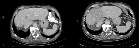Four Phase Liver Ct Scan In A Patient With A History Of Right Download Scientific Diagram