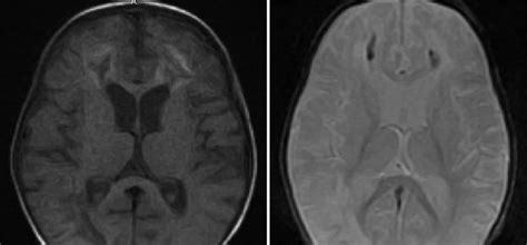 A And B Axial T1 Weighted Image And Gradient Recalled Echo Image Download Scientific Diagram