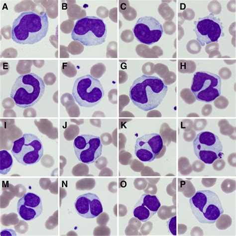 Lymphocyte Nuclei Of Nodal Marginal Zone Lymphoma Mimicking
