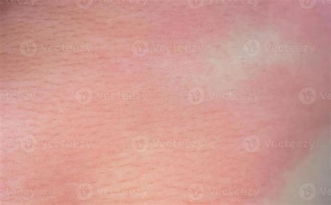 Schweres Ekzem Hautausschlag Und Allergische Reaktion Symptom Bei Kleinen Asiatischen