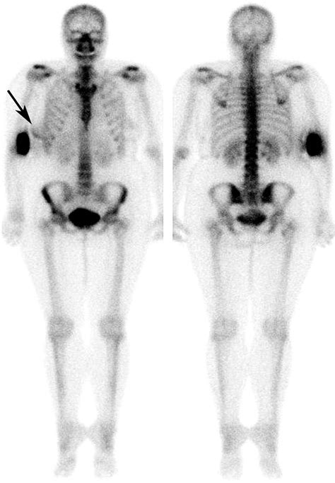 Nuclear Medicine Bone Scan