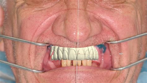 Matrix® Full Arch Solution For Your Dental Clinic