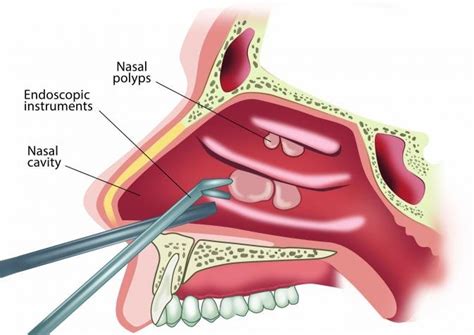 Nasal Polyps Treatment In Kolkata Orange Dental And Ent Care Centre