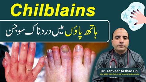 Understanding Chilblains Causes Symptoms And Treatment Dr Tanveer