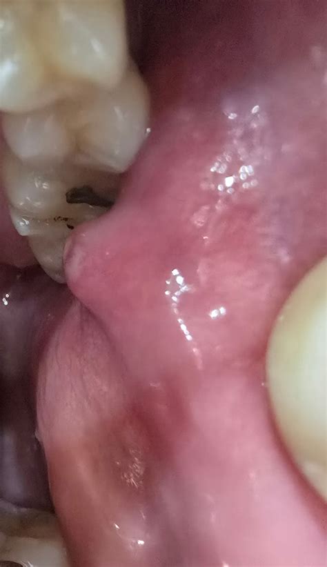 입 안 왼쪽 벽에 혹같은게 있음 지식in