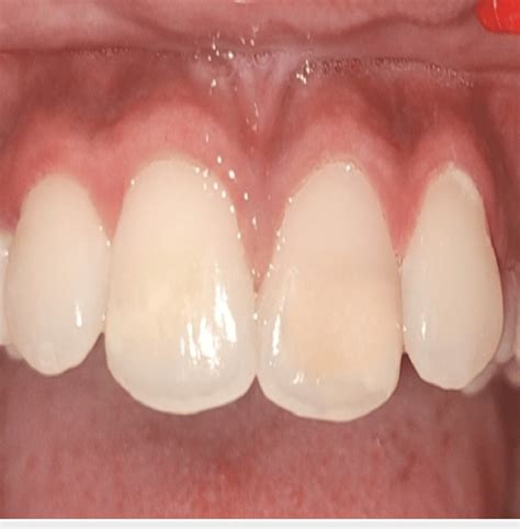 Postoperative Image Of The Upper Left Central Incisor After Finishing