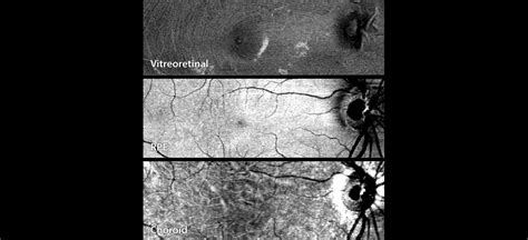 Heidelberg Spectralis Oct 2 Jody Myers Eye Equipment