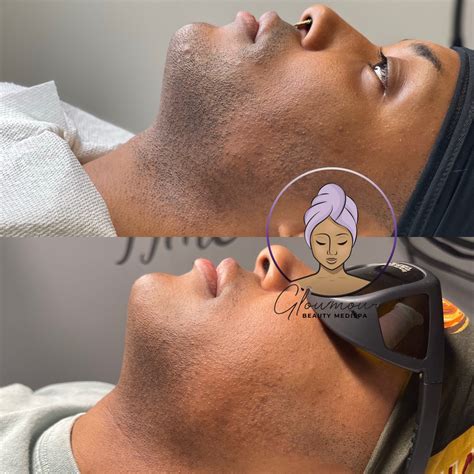 Best Laser Hair Removal Service In Tampa