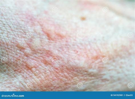 Skin Stock Image Image Of Macro Bumps Medical Care 94192981