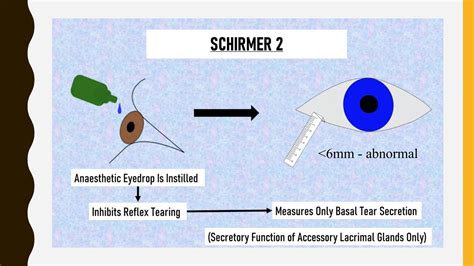 Dry Eye Causes Aetiology Pathogenesis Treatment Pptx