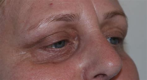 Chemical Peel The Karri Clinic