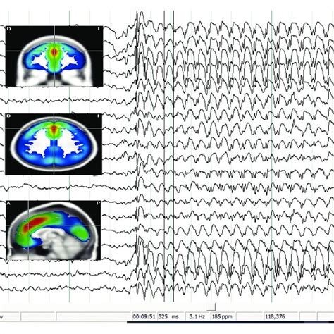 Eeg With Generalized Spike Wave Discharge At 31 Hz In Patient With