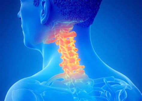 Cervical Posterior Decompression And Fusion Cpdf Neurosurgeon St