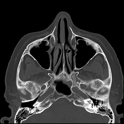 Bilateral Palatine Tonsilloliths On Opg And Ct Radiopaedia 75167 86247