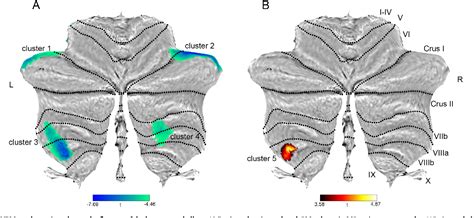 Cerebellar Gray Matter Alterations Predict Deep Brain Stimulation