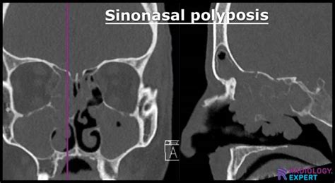 Ct Sinus