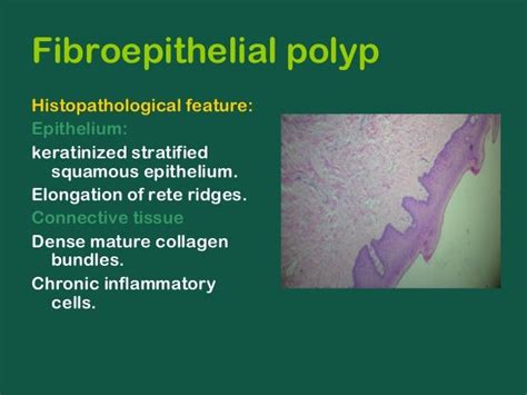 Oral Medicine Case Fibro Epithelial Polyp