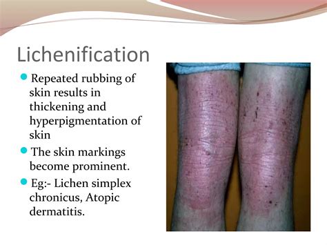 Skin Lesions Ppt