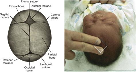 Fetal Suture Lines