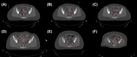 Figure 1 From Semi Automatic Sigmoid Colon Segmentation In Ct For