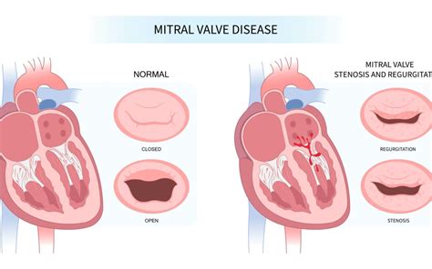 Mitral Stenosis Archives Longmore Clinic