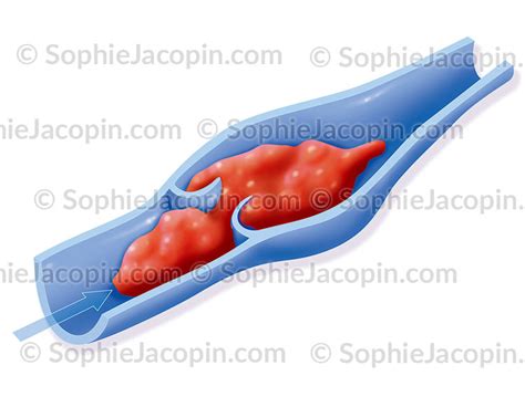 PHLÉBITE illustration medicale Sophie Jacopin