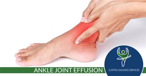 Ankle Joint Effusion Capitol Imaging Services