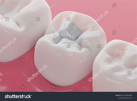 Chipped Wisdom Tooth