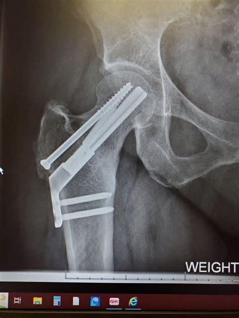 6 Month Post Op X Ray R Orif