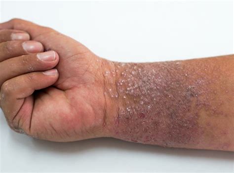 Eczema Atopic Dermatitis — Medical Secrets