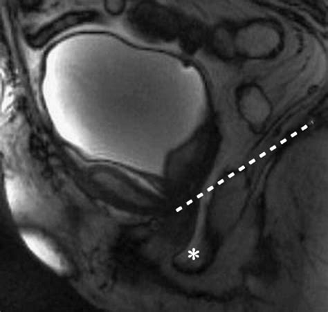 Magnetic Resonance Imaging Of Pelvic Floor Dysfunction Radiologic Clinics