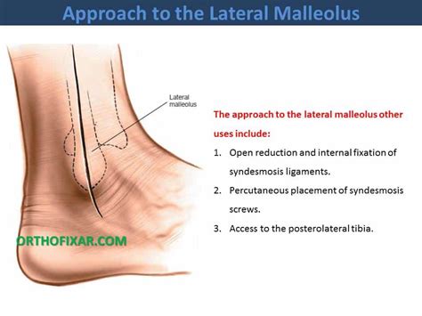 Approach To The Lateral Malleolus • Orthofixar 2025