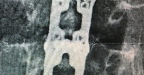 Thoracic Laminectomy Non Moto Motocross Forums Message Boards