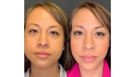 Botox Cpt Code 2025 Mary Quinn