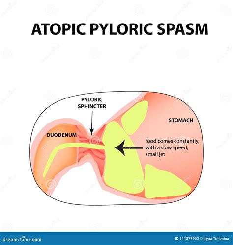 Spasms Of The Pylorus Pylorospasm Atonic Pyloric Sphincter Of The