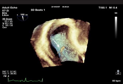 Three Dimensional Transesophageal Echocardiography Showing The Clot