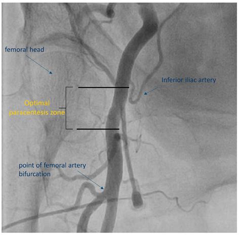 Femoral Sheath Anatomy