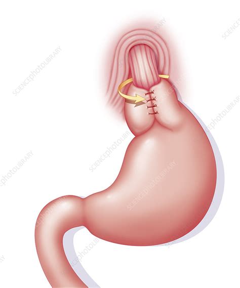 Fundoplication Drawing Stock Image C0171903 Science Photo Library
