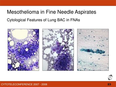 Ppt Malignant Mesothelioma In Effusions And Fine Needle Aspirates