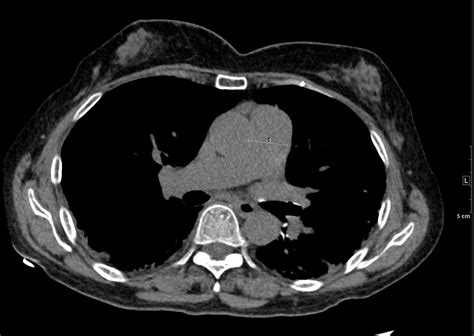 Scleroderma Lungs