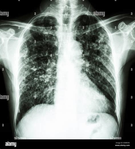 Chest X Ray Consolidation Vs Infiltrate