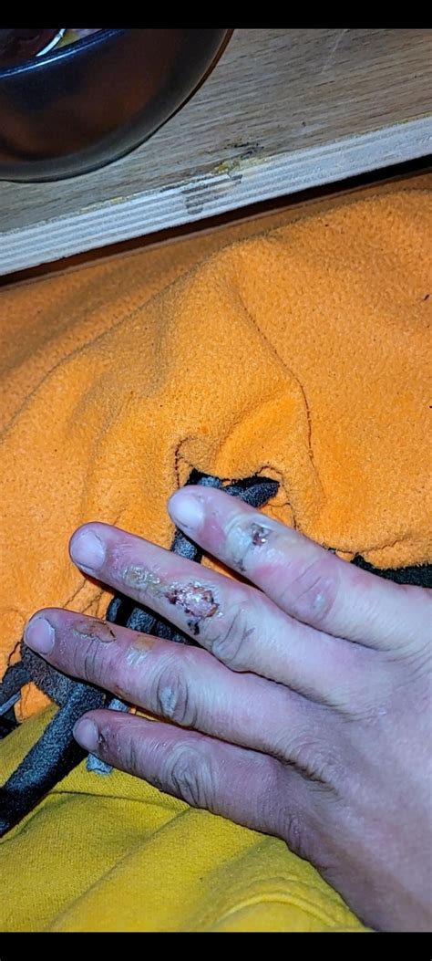 1st Second Or 3rd Degree Burns Rmedical