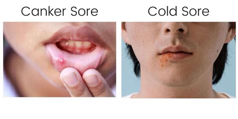 Canker Sore Vs Cold Sore Whats The Difference With Pictures — Canker Shield