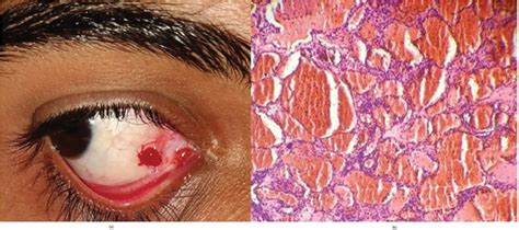 Figure 1 From Cavernous Hemangioma Of The Conjunctiva Semantic Scholar