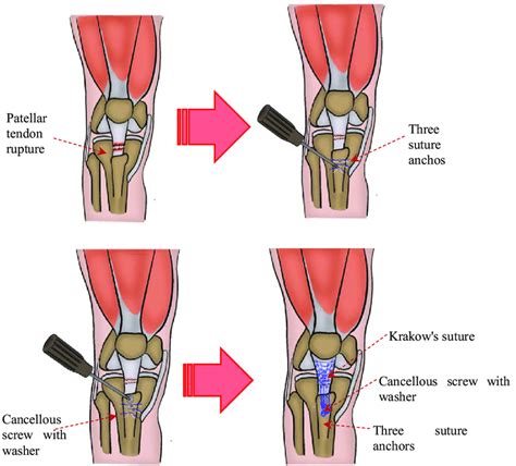 Patellar Tendon Repair