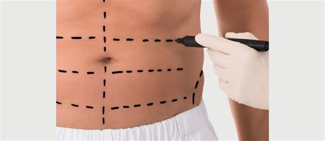 Panniculectomy Vs Tummy Tuck Which One Is Right For You