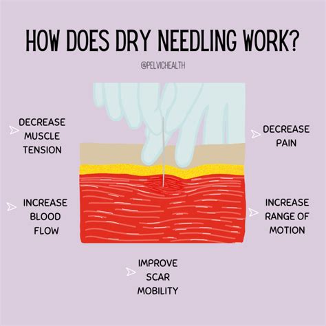 Dry Needling How Its Relevant To Pelvic Health