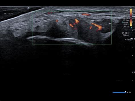 Partial Tear Common Extensor Tendon Ultrasound Cases