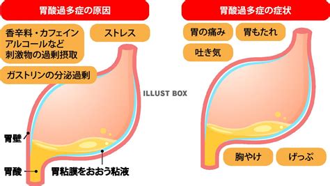 無料イラスト 胃酸過多の症状と原因png・cseps）